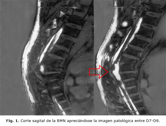 Hallazgo de quiste ependimario (ependimoma) intramedular en el estudio de la vía piramidal y ...